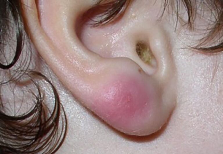 Borreliainfektion (Lyme borrelios) – Reserådet – Frisk på Resan
